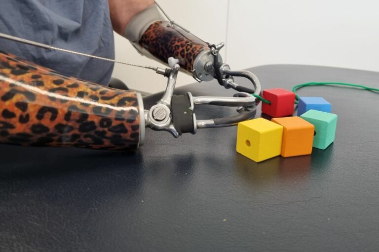 Prosthetic Arms & Hands | Northern Prosthetics